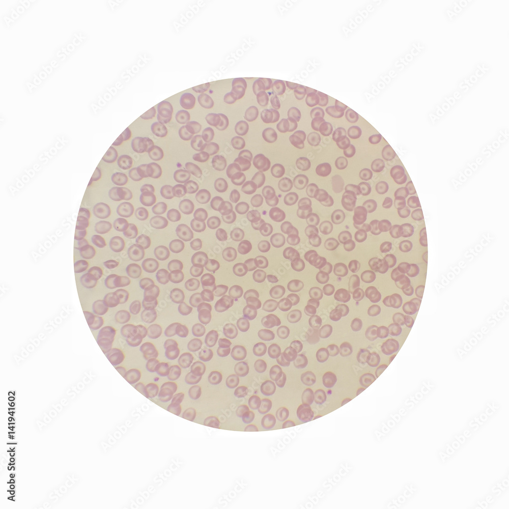 Blood smear under microscope present abnormal red blood cell morphology ...