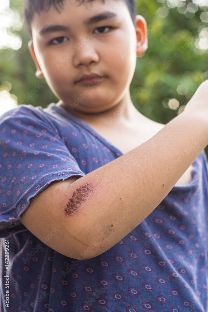 Wounds caused by falling on elbow, the boy look elbow Stock Photo ...