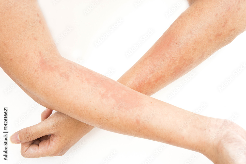 Skin rashes, allergies contact dermatitis ,allergic to chemicals ...