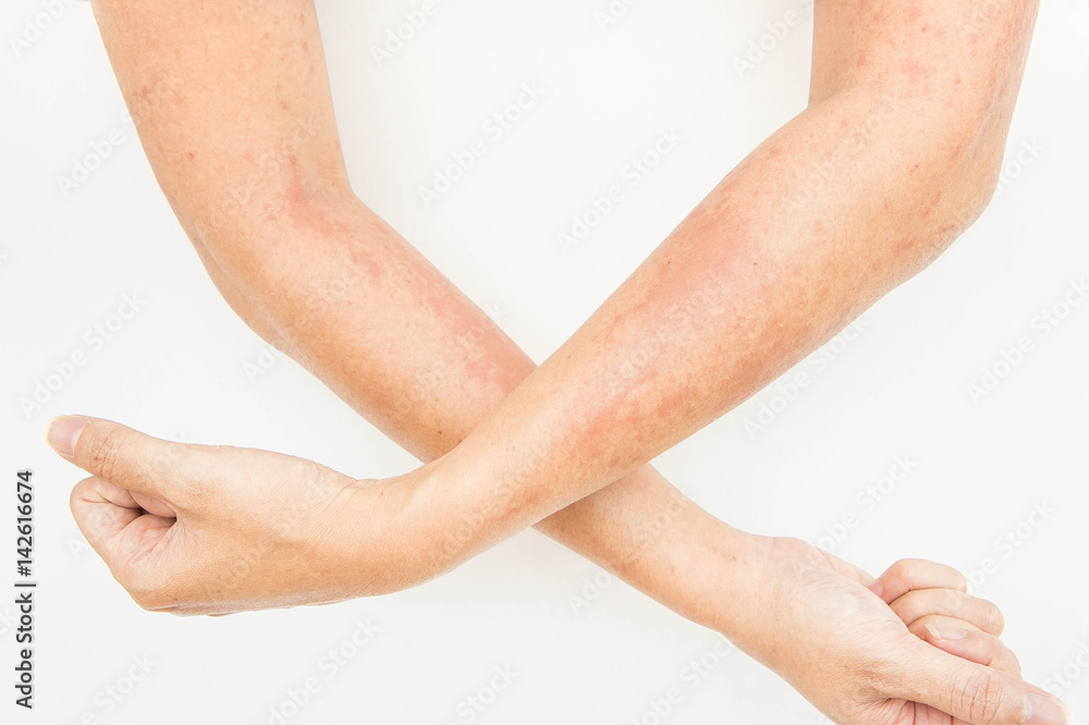 Skin rashes, allergies contact dermatitis ,allergic to chemicals ...