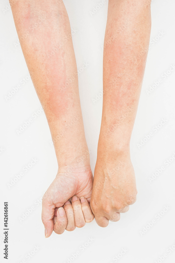 Skin rashes, allergies contact dermatitis ,allergic to chemicals ...