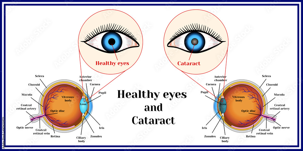 Healthy eyes and cataract (opacity of the eye lens). Stock Vector ...