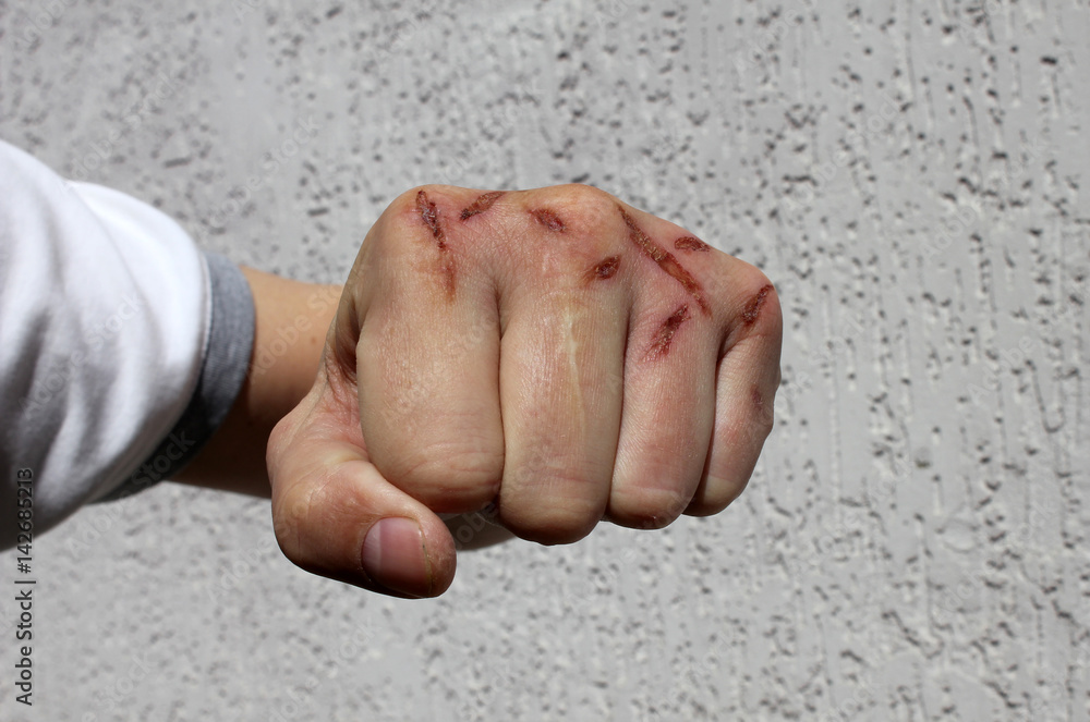 Damaged hands Stock Photo | Adobe Stock