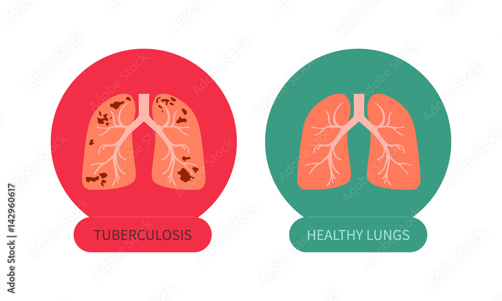 Tuberculosis Versus Healthy Lungs Symbol Tb Awareness Sign Medical