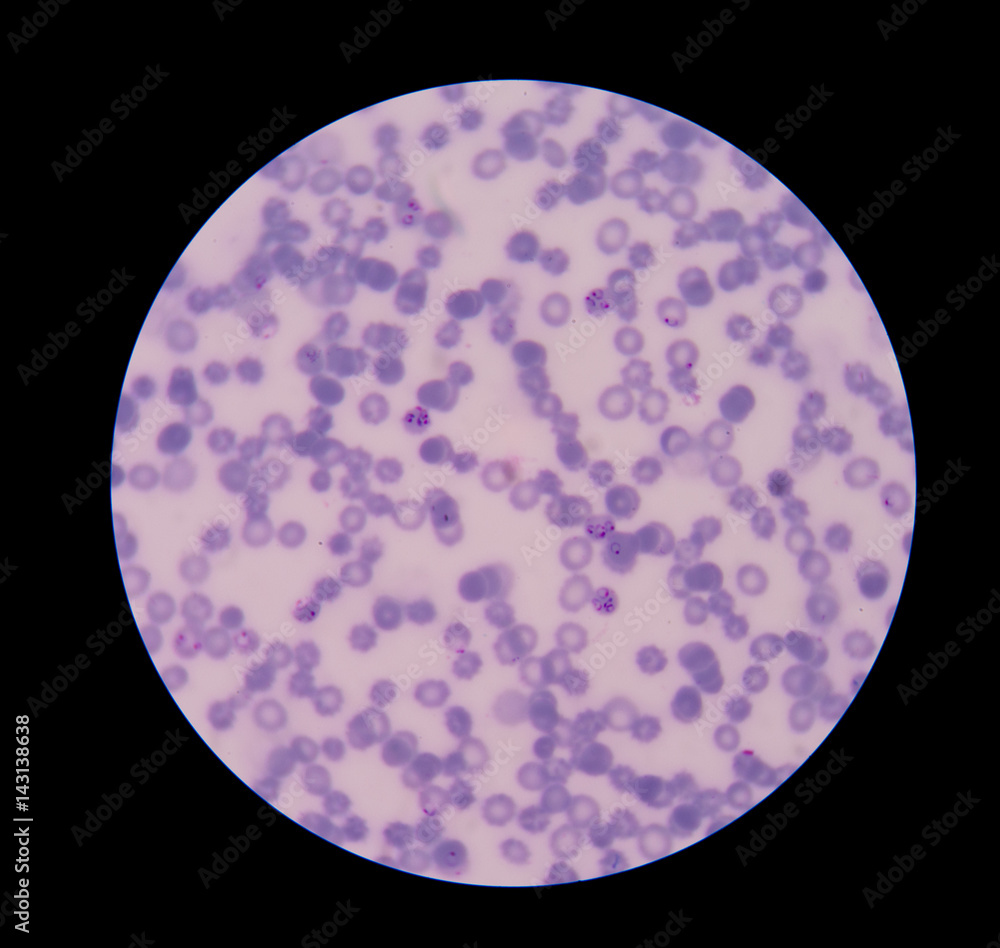 Malaria ring form infection on red blood cells. Stock Photo | Adobe Stock