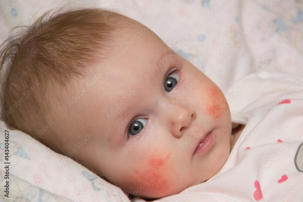Surprised little baby girl with an allergic rash on her cheeks lies on ...