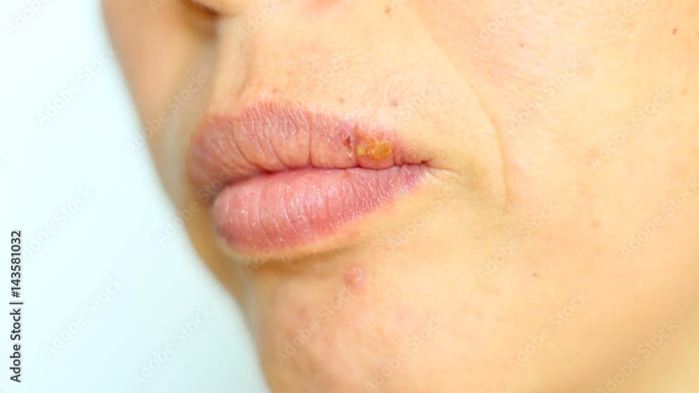 Herpes labialis, also called cold sores among other names, is a type of ...