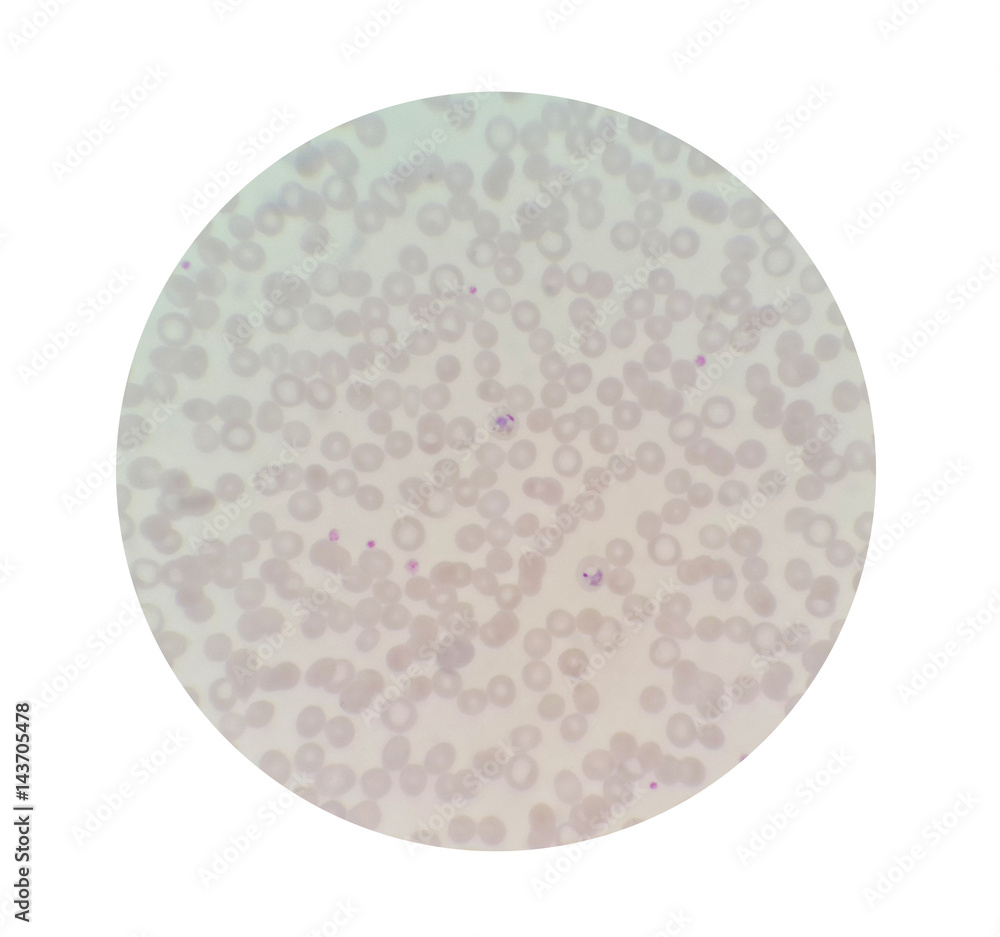 Microscopic examination of thin blood films smear from malaria infected ...