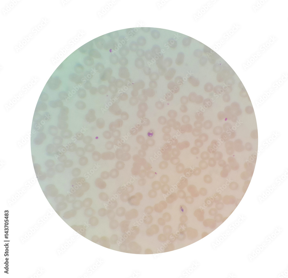 Microscopic examination of thin blood films smear from malaria infected ...