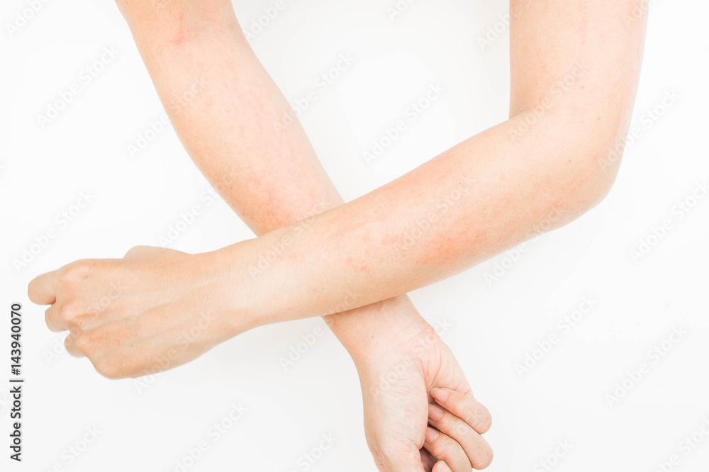 Rash allergy from touching arms ,eczema, Dermatitis Stock Photo | Adobe ...