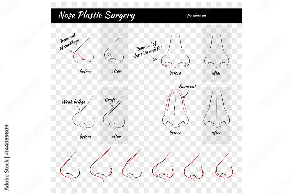 Plastic Surgery. Nose. Vector illustration. Nose Templates. Set of ...