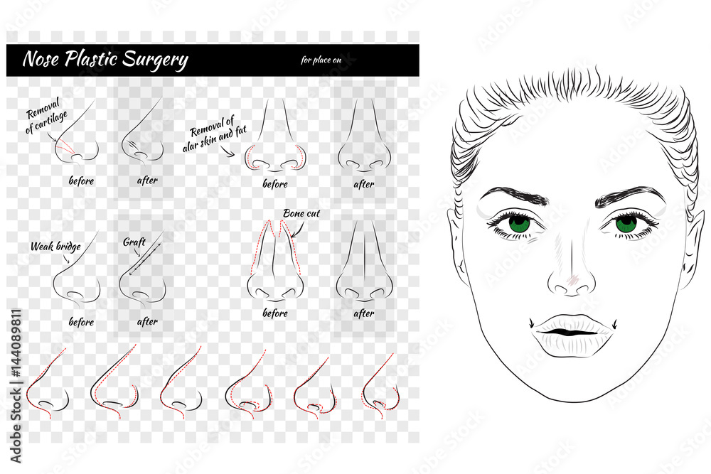 Plastic Surgery. Nose. Vector illustration. Nose Templates. Set of ...