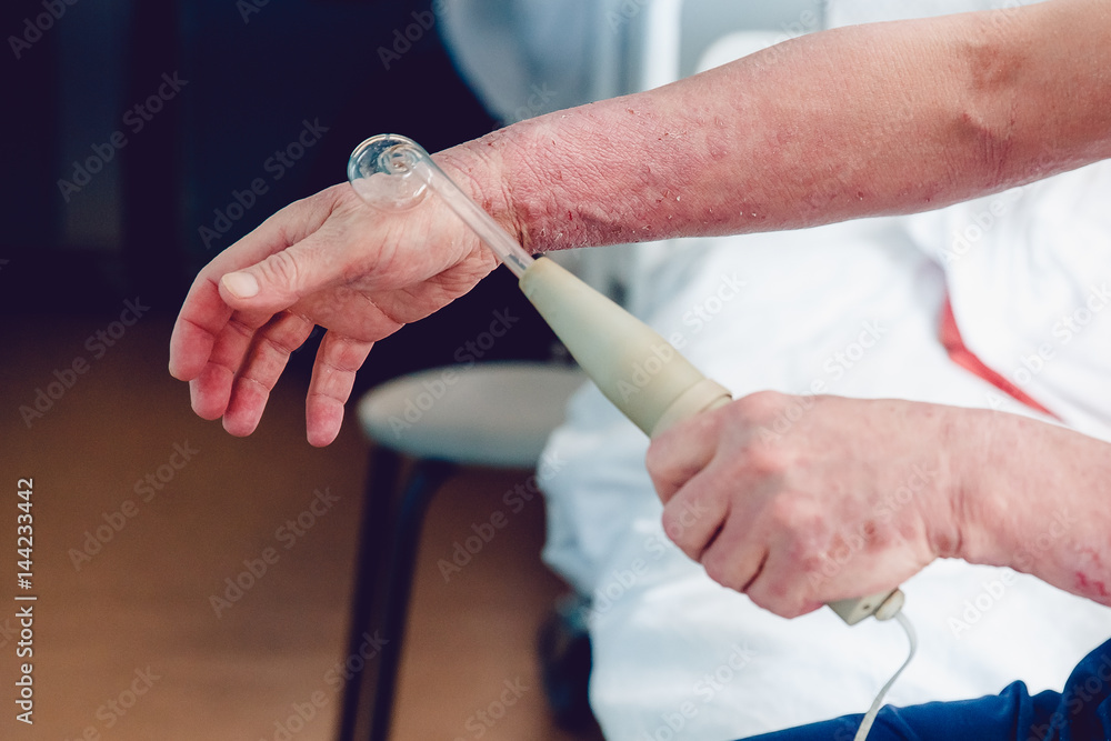 patient with a skin disease uses a Darsonval apparatus for the ...
