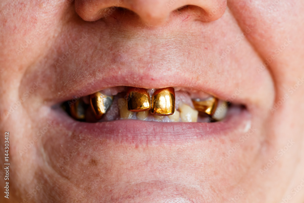 Bad teeth. No teeth. The jaw of the old man. Gold teeth. macro. Stock ...