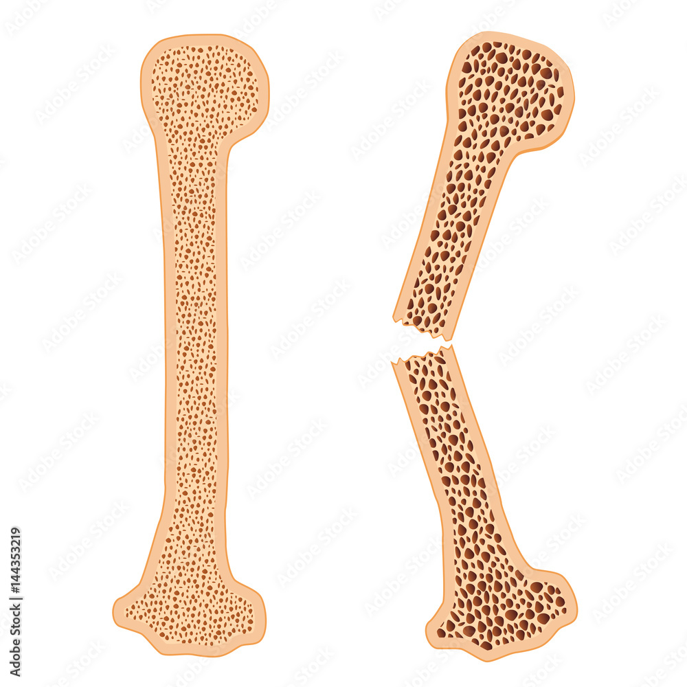 Healthy bone and broken bone with osteoporosis. Stock Vector | Adobe Stock