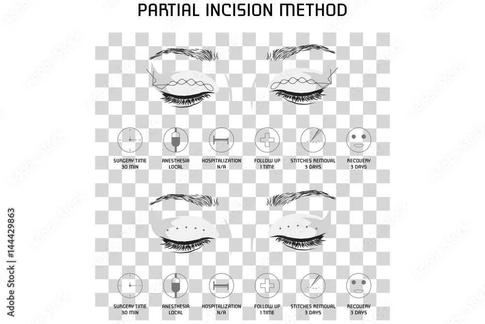 Full Incision Method. Vector Illustration. Medical Poster. Stock Vector ...