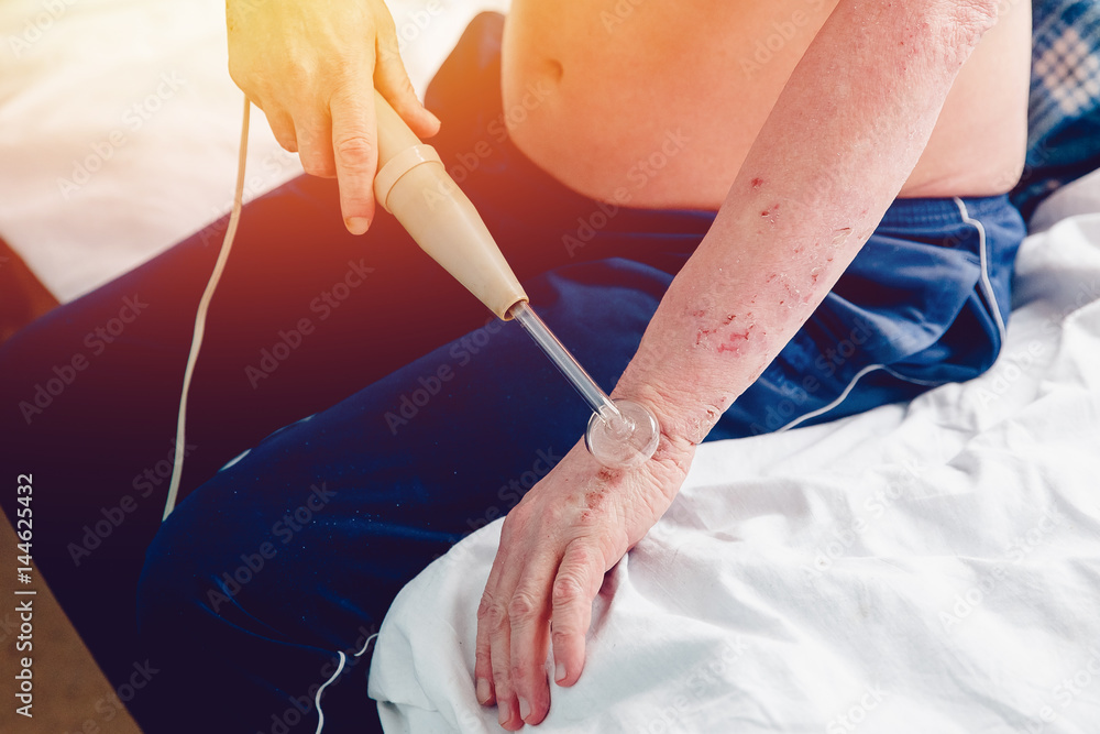 patient with a skin disease keeps the Darsonval electric shock device ...