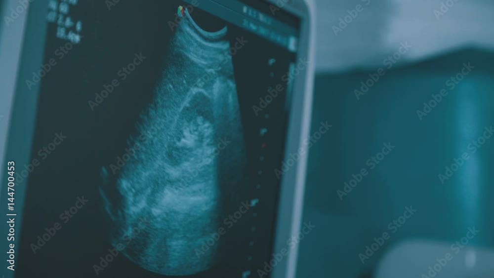 Ultrasound machine doctor s hand usg investigation USCG. Screen of echo ...