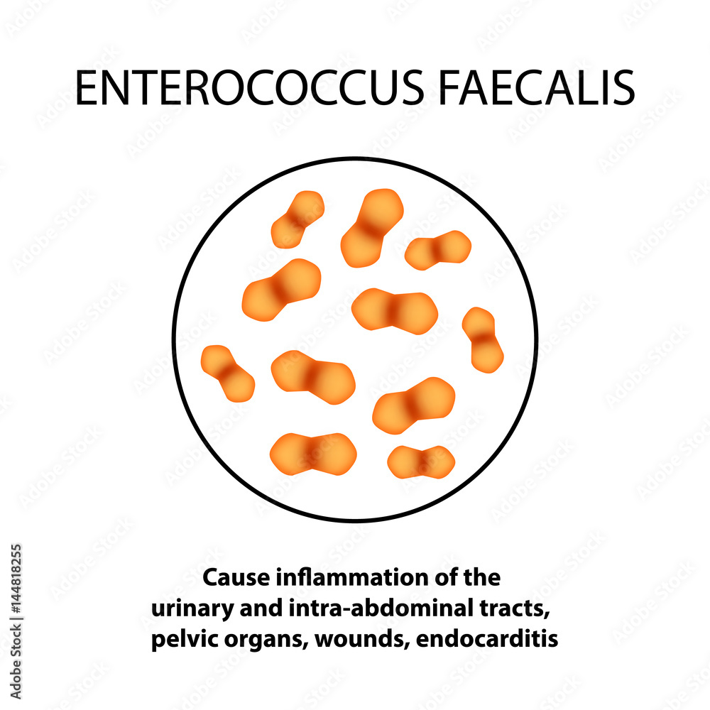 Enterococcus faecalis. Pathogenic flora. The bacterium causes ...
