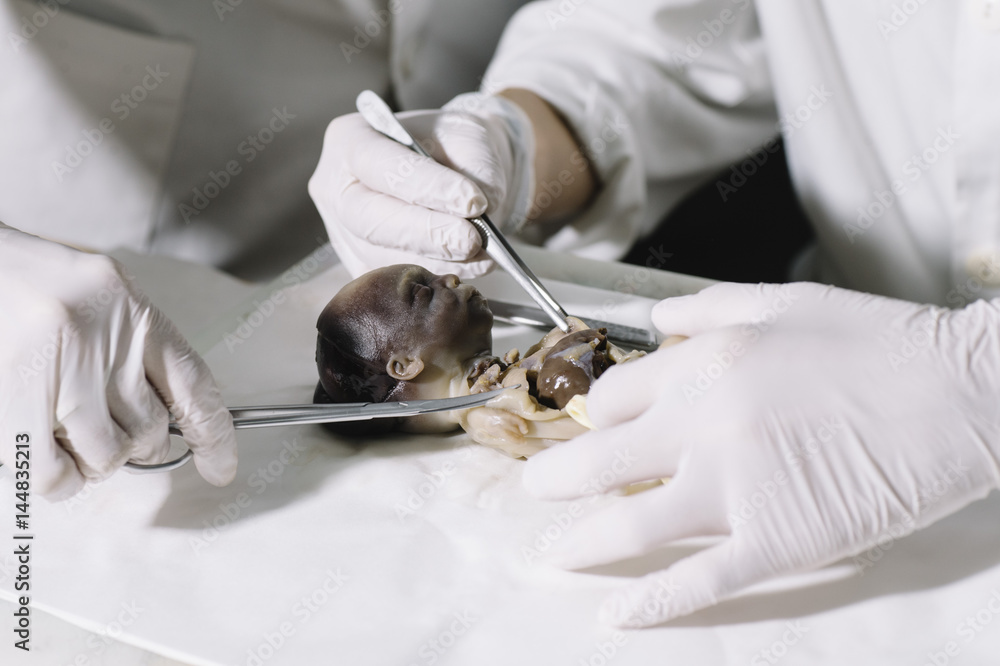 Medics Preparing Dead Fetus Stock Photo Adobe Stock medics-preparing-dead-fetus-stock-photo-adobe-stock