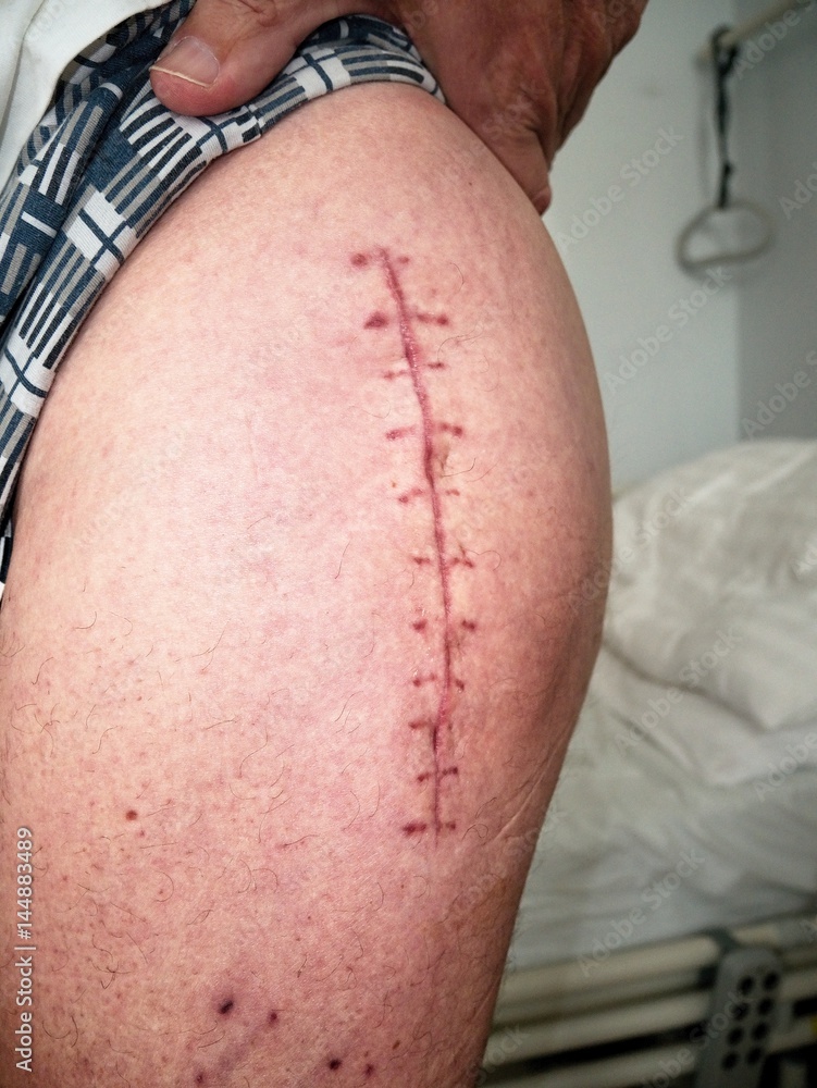 Scar following surgery of hip joint. Replacing of the devastated hip ...