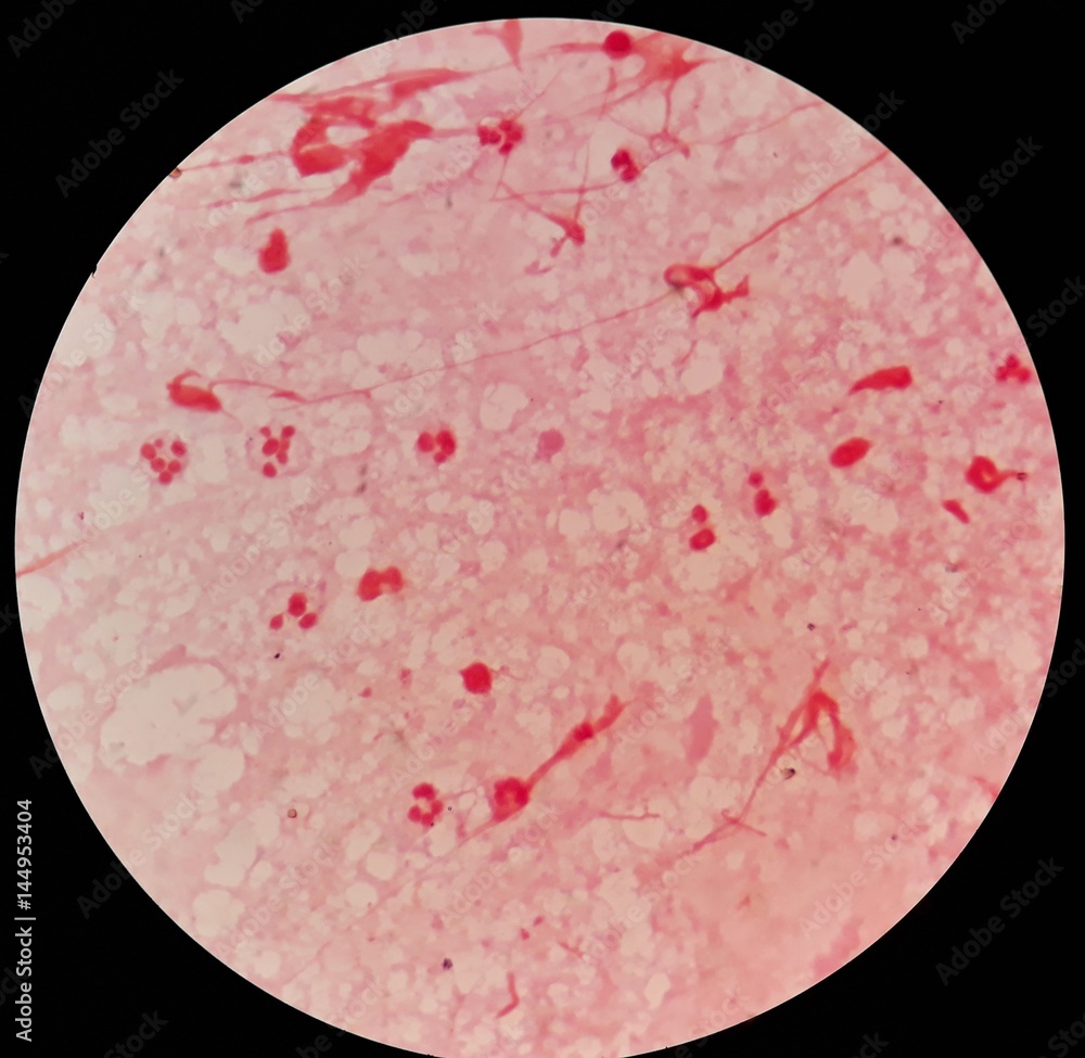 Smear of sputum specimen Gram's stained under 100X light microscope ...