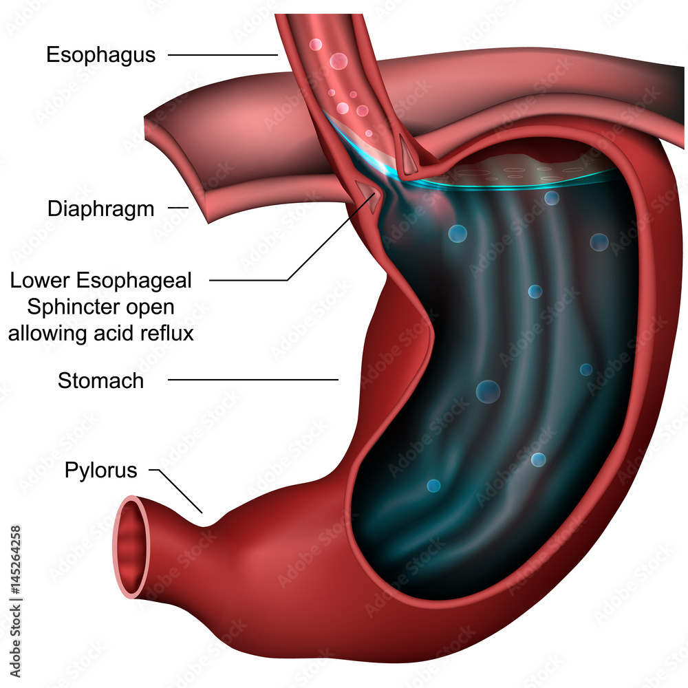 Stomach and esophagus with gastric reflux injury, vector illustration ...