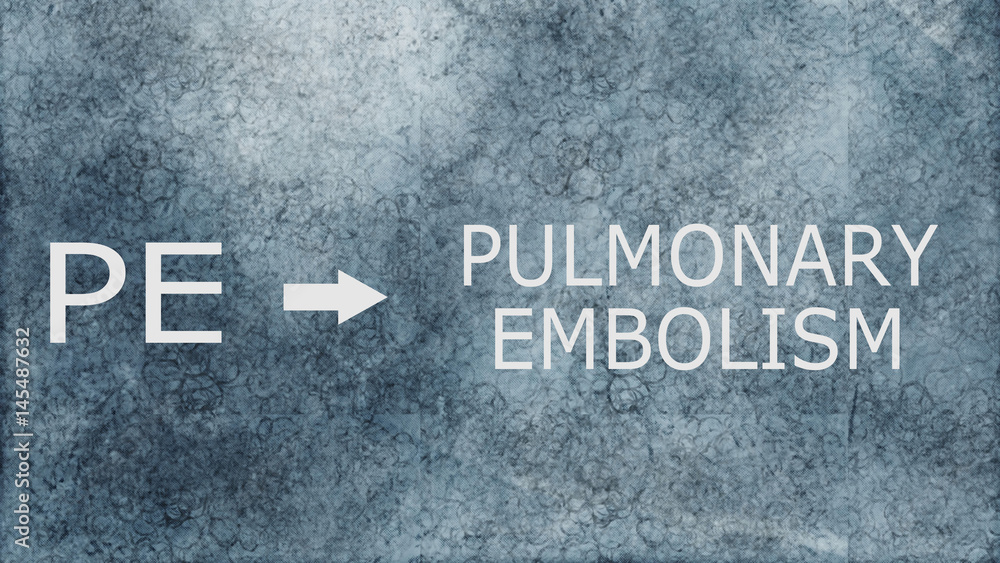PE- Pulmonary Embolism Stock Illustration | Adobe Stock