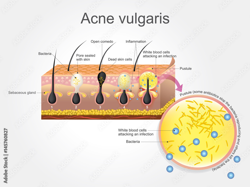 Acne Vulgaris skin. Vector graphic. Stock Vector | Adobe Stock