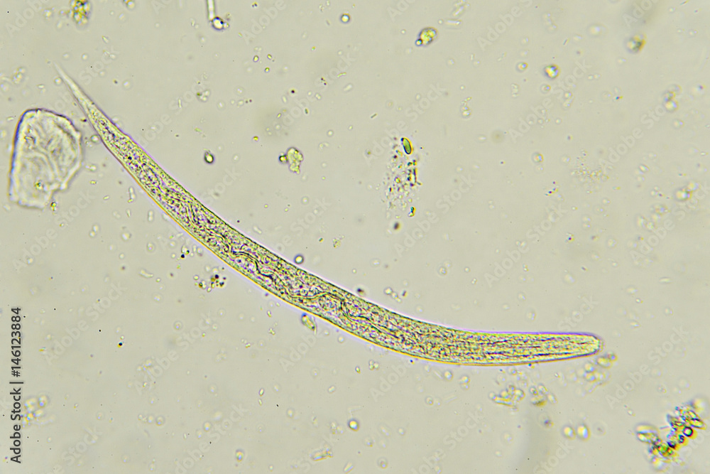 Strongyloides stercoralis (threadworm) in stool, analyze by microscope ...
