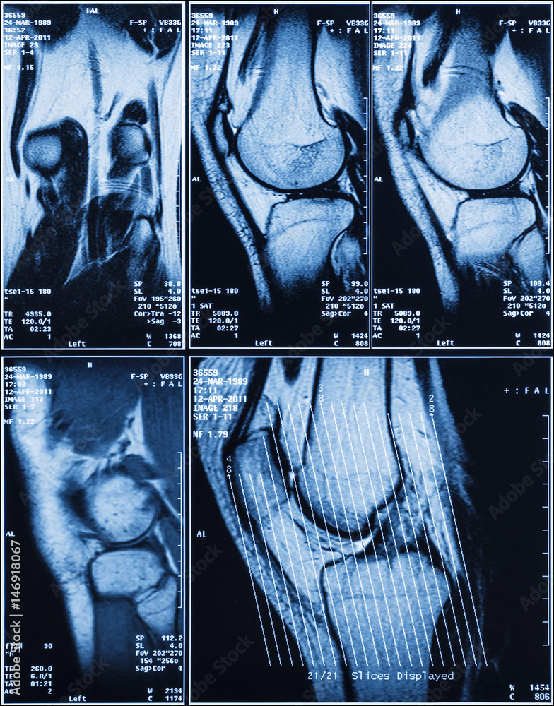 MRI of Human Knee for Medical Diagnosis Stock Photo | Adobe Stock