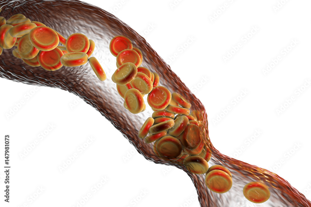 Vasoconstriction, clot formation. Red blood cells flowing through blood ...