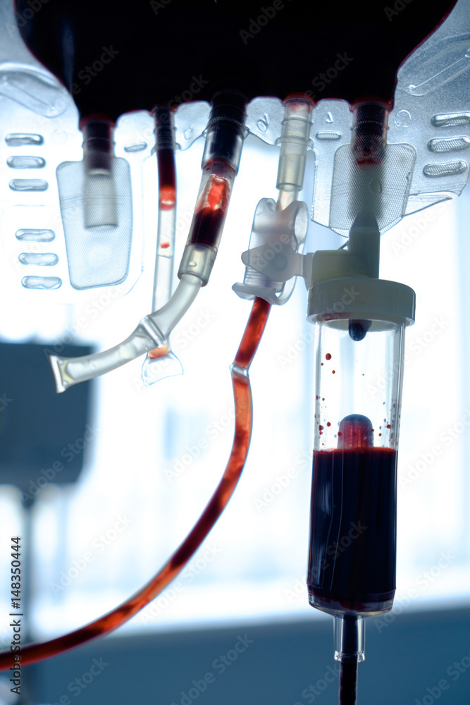 pack of blood. Doze of blood. Hemotransfusion in hospital, close view ...