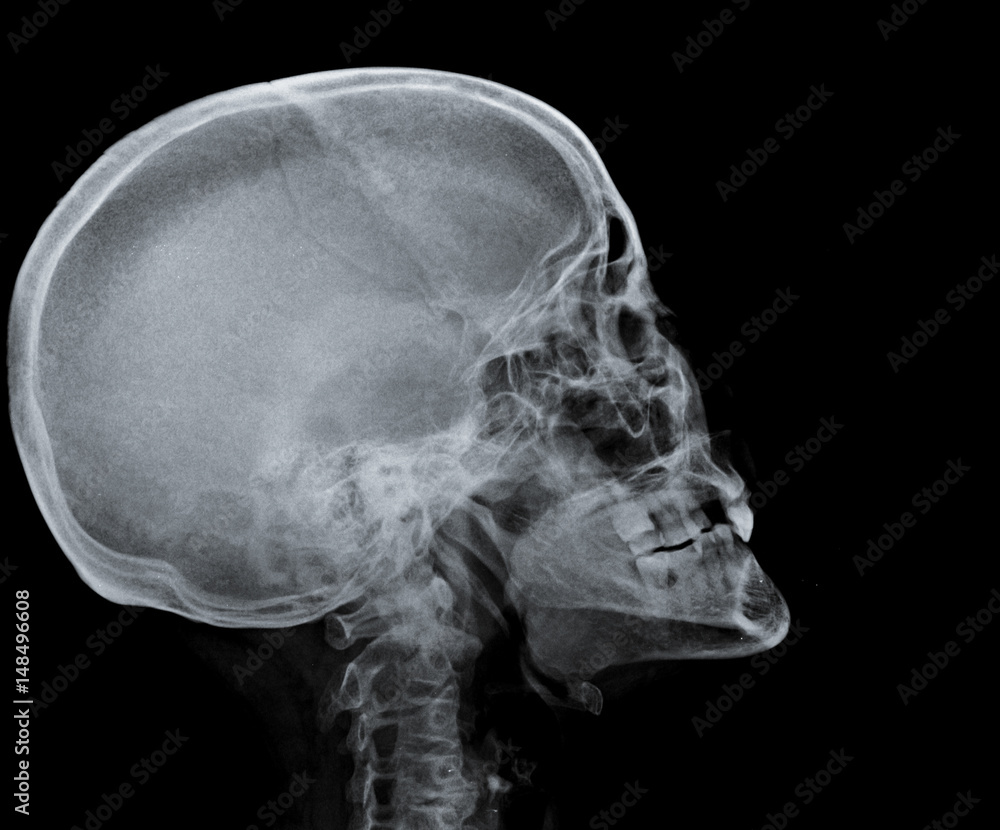 radiography of skull. Stock Photo | Adobe Stock