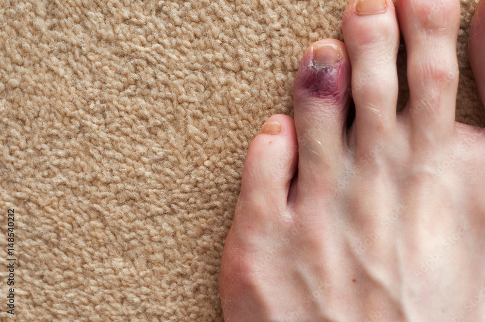 Broken toe showing bruising on skin due to injury Stock Photo | Adobe Stock