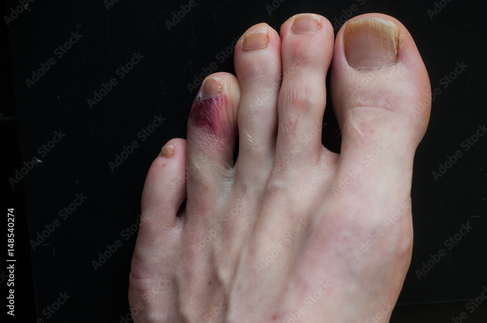 Broken toe showing bruising on skin due to injury Stock Photo | Adobe Stock