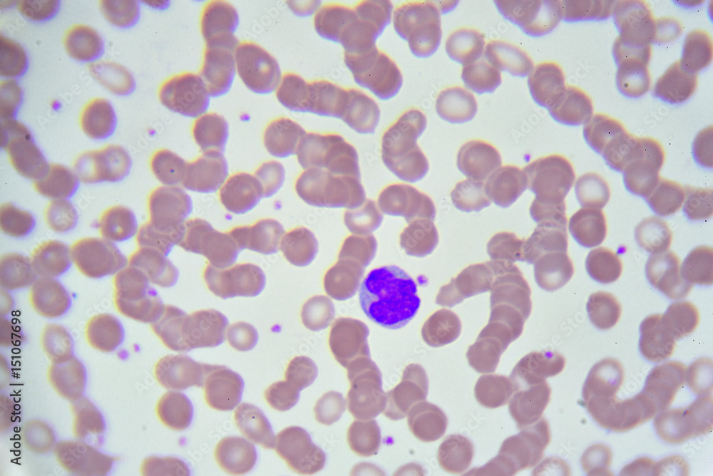 White blood cells in in blood smear, analyze by microscope Stock Photo ...