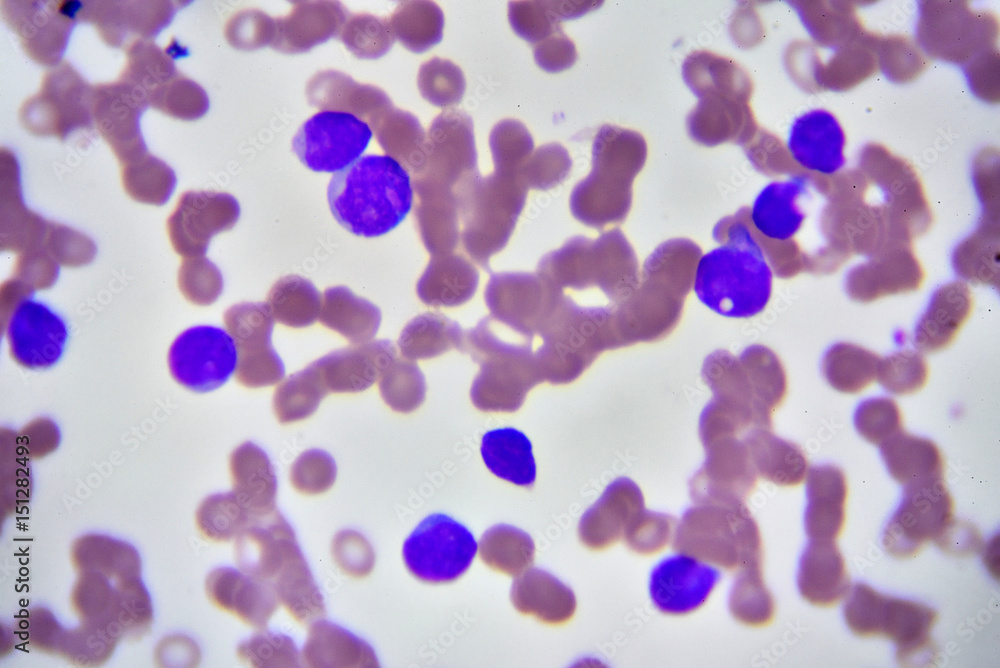 Leukemia cells in blood smear, analyze by microscope Stock Photo ...