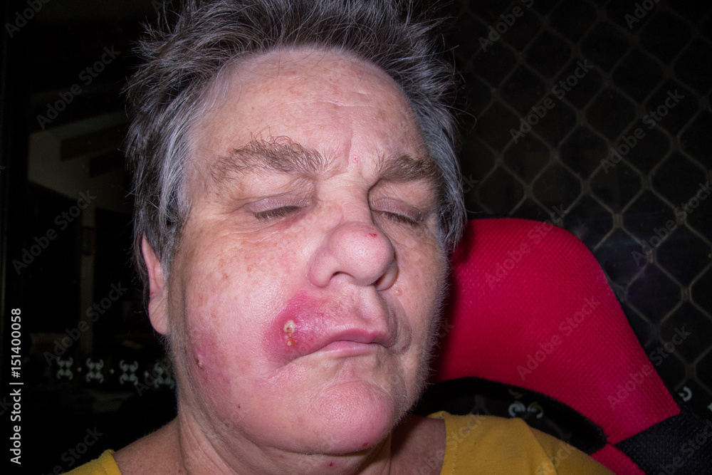 Staph Infection On Face