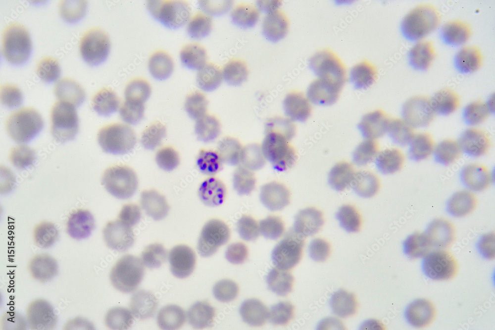 Red blood cells infected with malaria parasite (Plasmodium falciparum ...