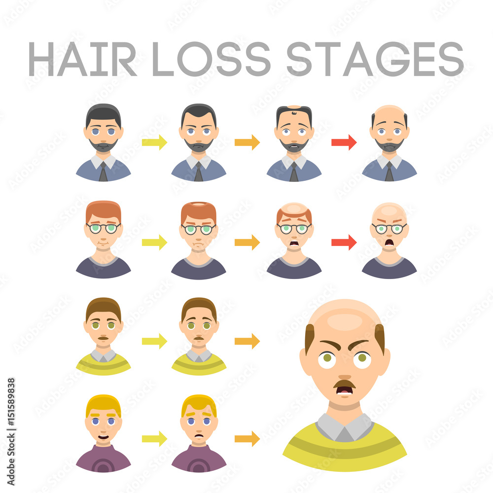 Information chart of hair loss stages types of baldness illustrated on ...