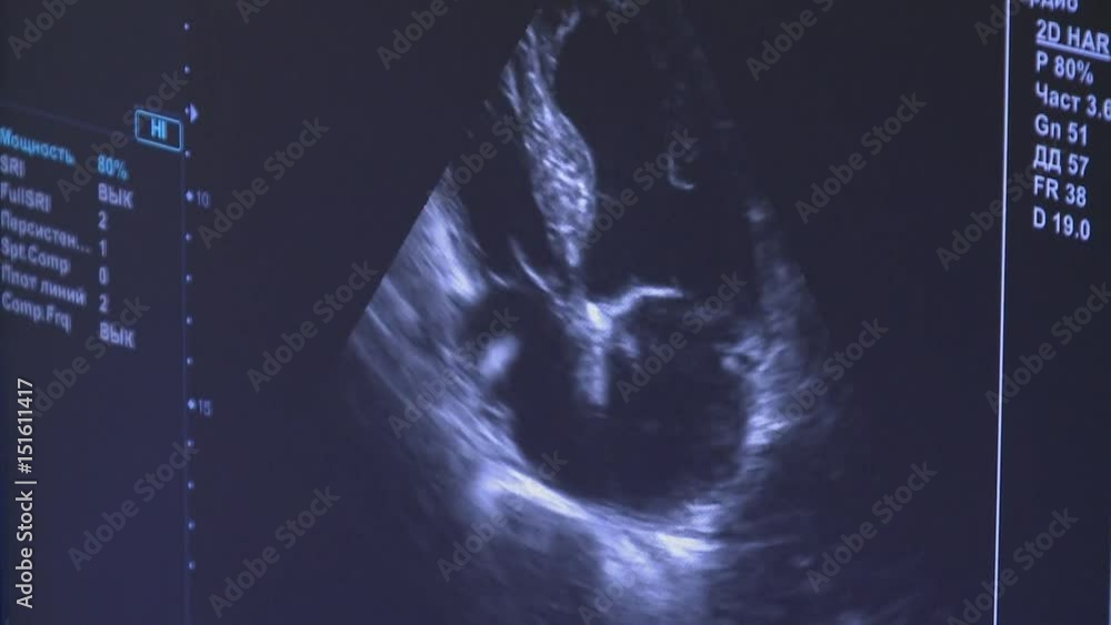 Medical ultrasound scan heart Echocardiogram shows views of valsalva ...