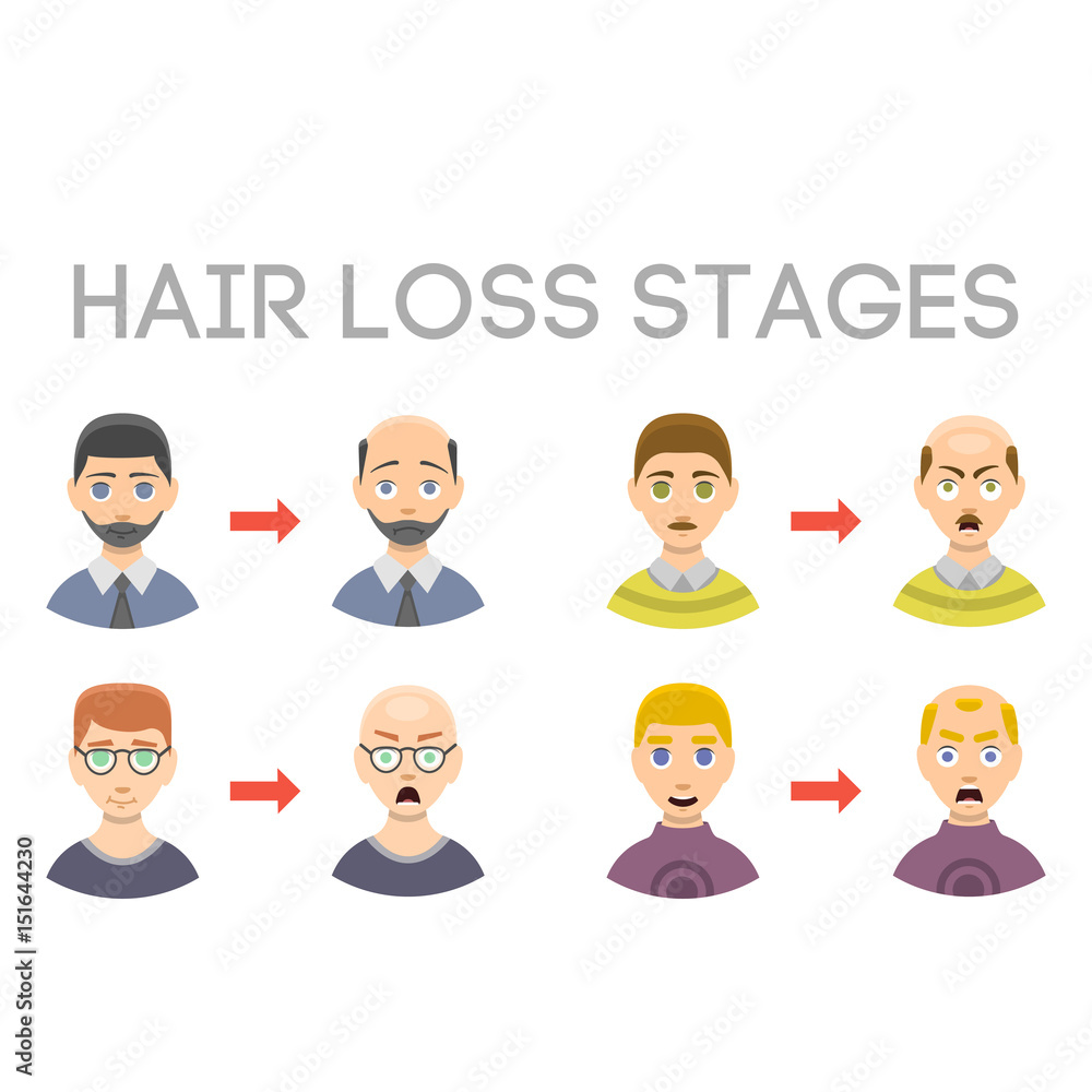 Information chart of hair loss stages types of baldness illustrated on ...