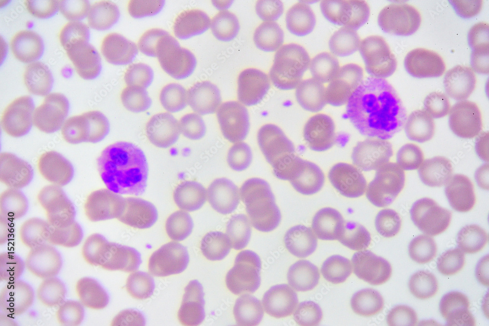 Neutrophil cell (white blood cell) in blood smear, analyze by ...