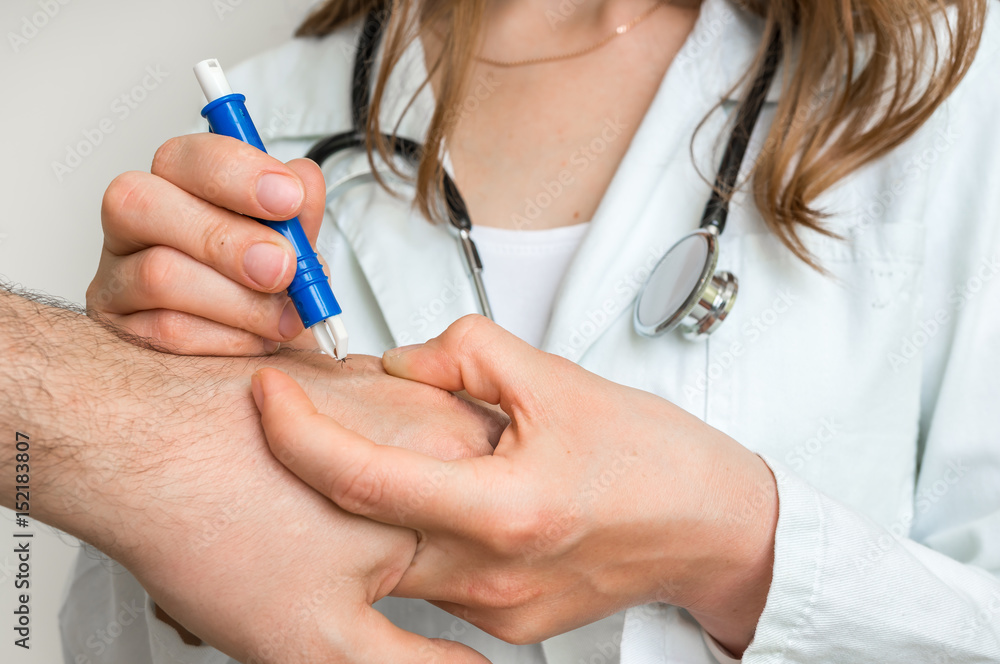 Doctor removing a tick with tweezers from hand of patient Stock Photo ...