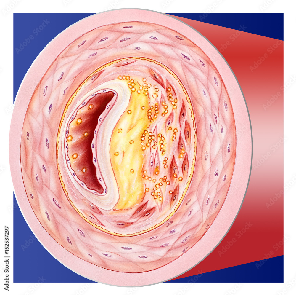 A clogged blood vessel, cutaway cross section. When cholesterol levels ...