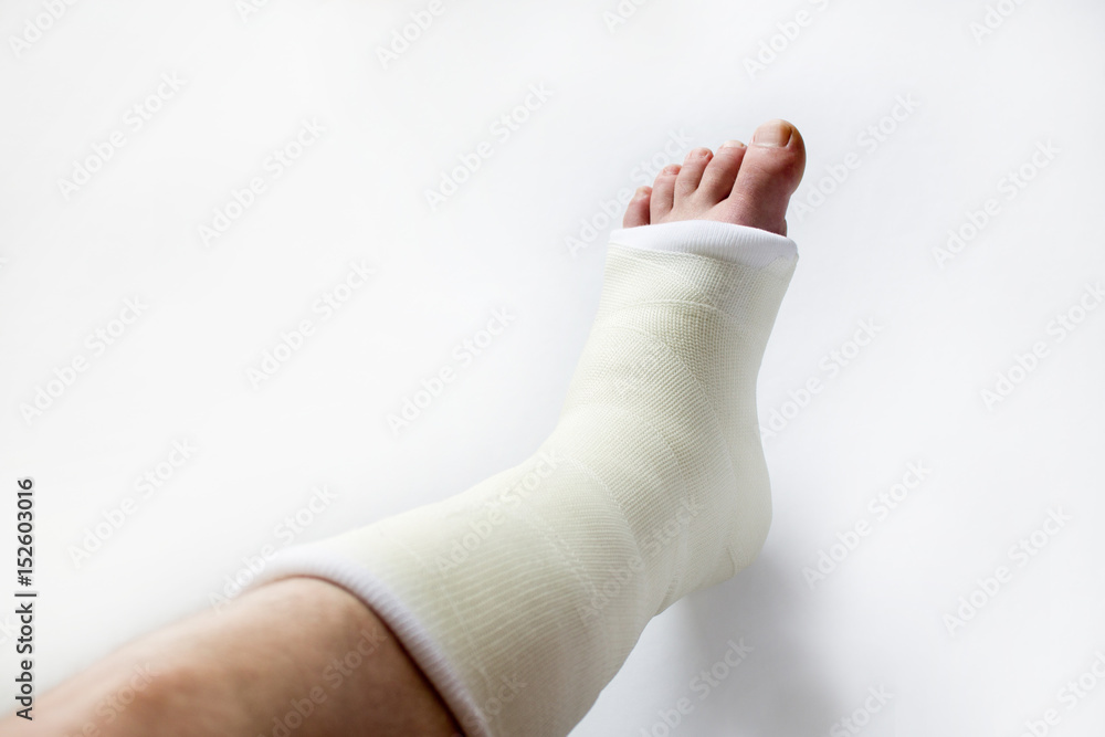 leg in plaster Stock Photo | Adobe Stock