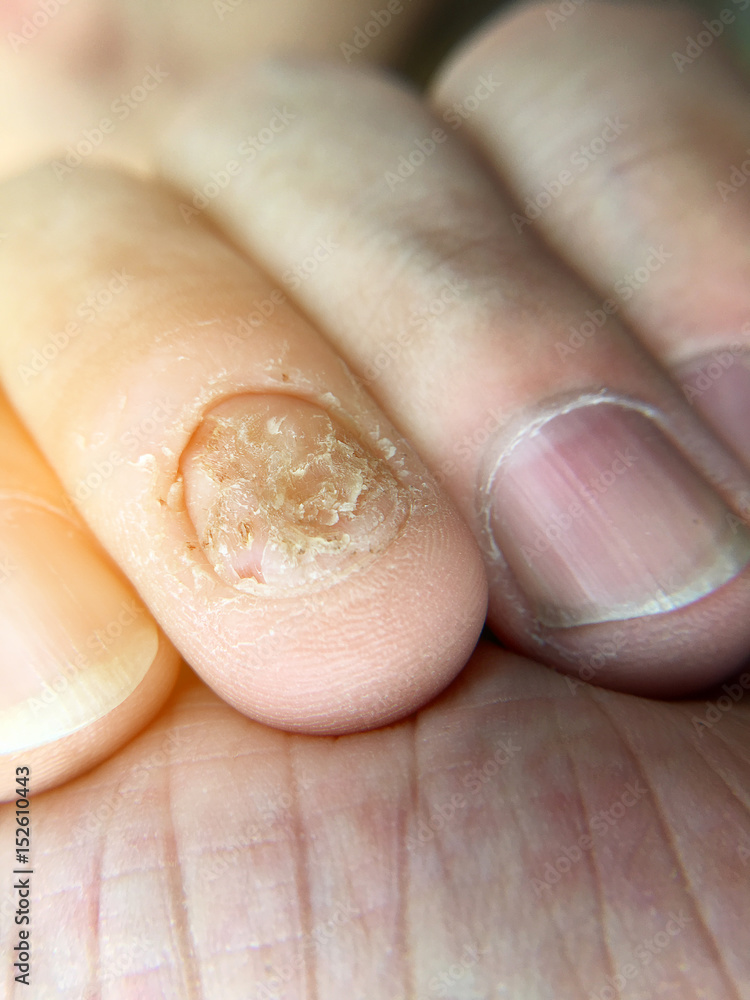 Fungal nail infection and damage on human hand. Finger with ...