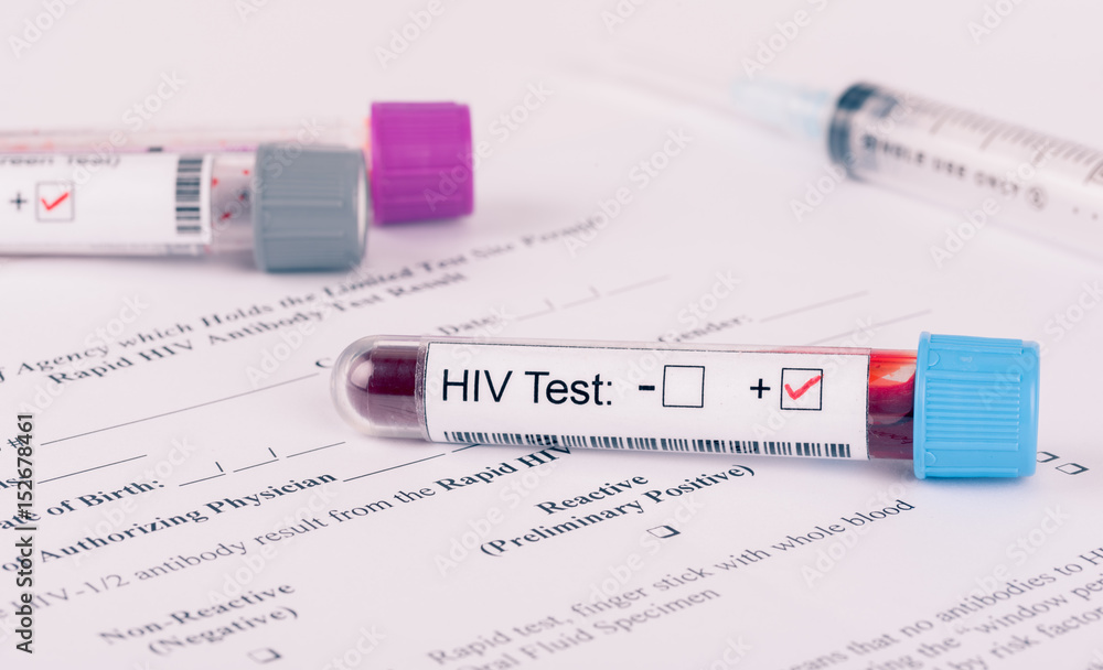 HIV positive test sample with medical forms Stock Photo | Adobe Stock