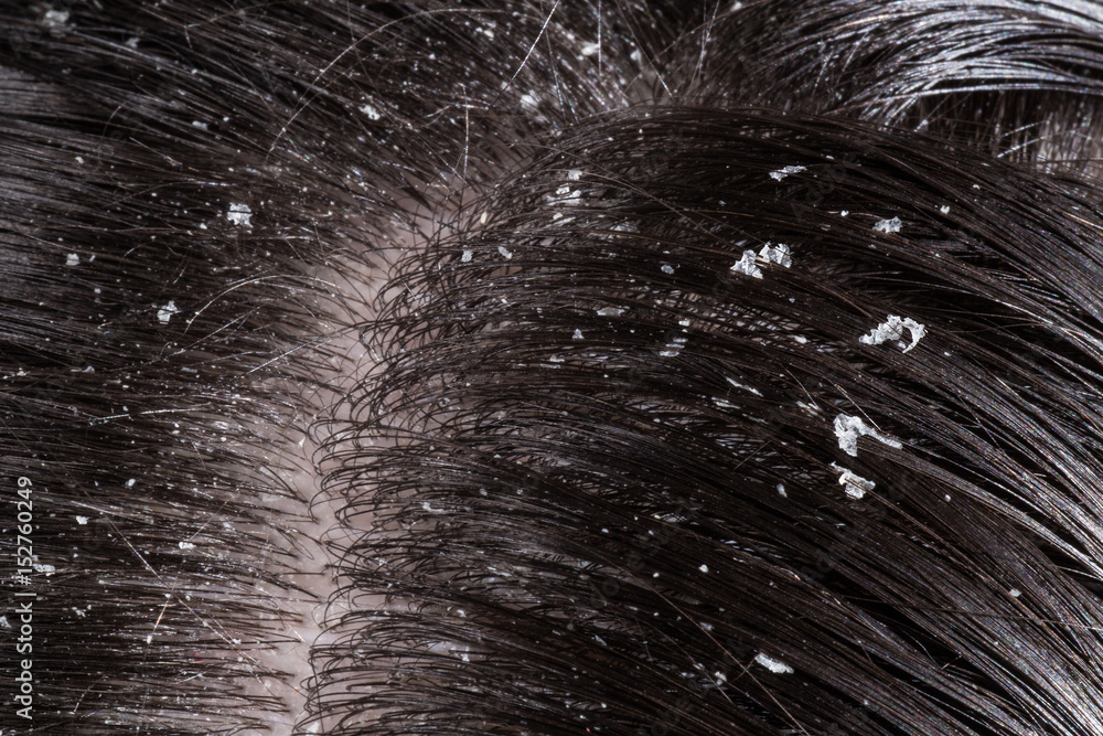 Dandruff on her dark hair Stock Photo | Adobe Stock
